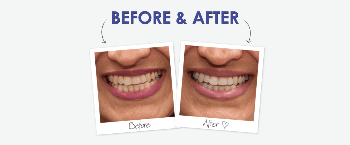 ProDental Teeth Whitening Serum | Isabella Garcia International